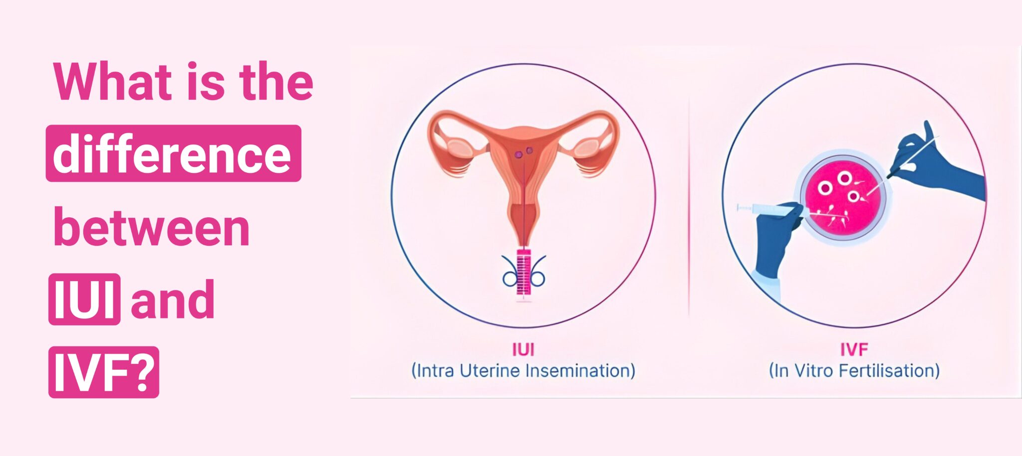 Difference Between IUI and IVF | IUI vs IVF success rate